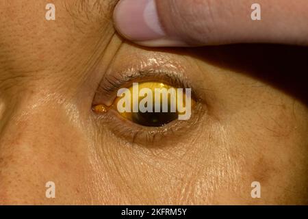 Deep jaundice in Asian male patient. Yellowish discoloration of skin ...