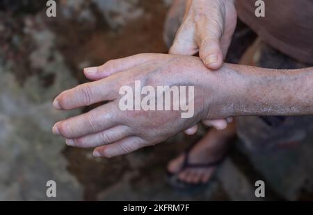 Unilateral edema of upper limb. Swollen hand and arm of Asian woman ...