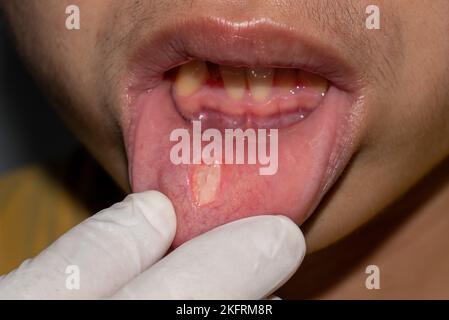 Aphthous ulcer or stress ulcer in mouth of Asian, child Stock Photo - Alamy