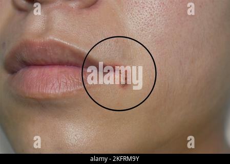 Angular stomatitis or angular cheilitis or perleche in asian young man ...