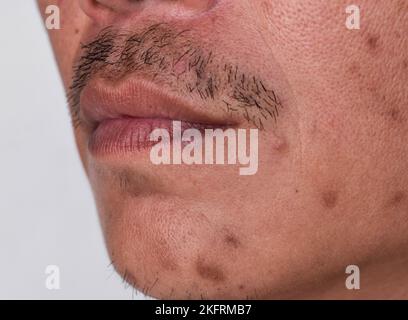 Small brown patches called age spots and scars on the face of Asian man ...