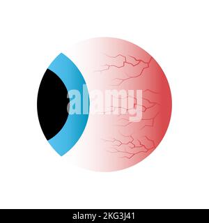 Red eye. Ill stress, sleep insomnia disorder, capillaries and pupils ...
