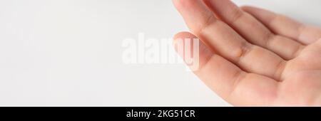 Common wart Verruca vulgaris on the skin of a child, papillomavirus in ...