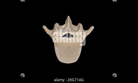 Superior view of human lumbar vertebra with herniated disc and spinal ...