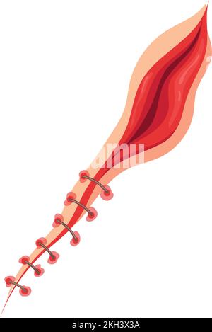 Skin incision wound. Bloody surgery stitch scar or cut on body ...