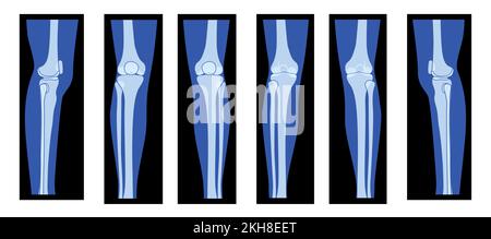 Human Knee Bones Front And Side View Anatomy, Vector Illustration Stock ...