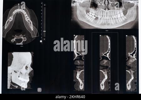 CT scan of a patient with malocclusion, missing chewing tooth and ...