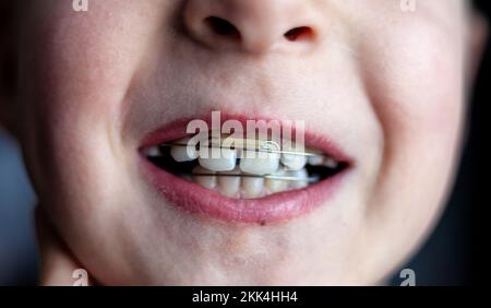 Orthodontist plates on children's teeth. Bite alignment. Orthodontic ...