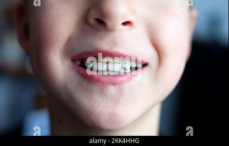 Orthodontist plates on children's teeth. Bite alignment. Orthodontic ...