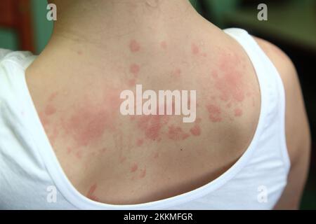 Close up allergic rash dermatitis eczema on man foot. Leg with red rash ...