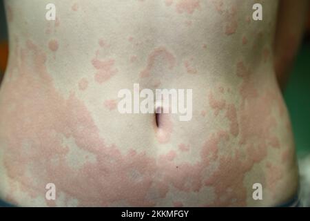 Close-up body with allergic rash, eczema on hands, skin with red bumps ...