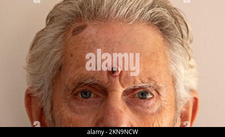 Keratoacanthoma skin cancer growth on a male forehead. Keratoacanthoma ...
