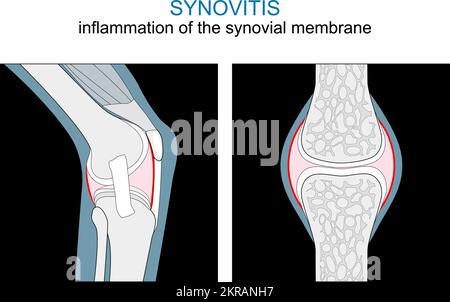 Synovial Knee Joint Stock Vector Image & Art - Alamy