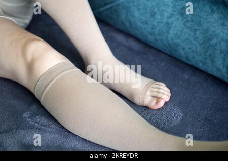 Chronic venous (vein) insufficiency in the leg of an adult woman ...
