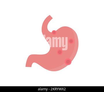 vector illustration of acute appendicitis, the inflammation of the ...