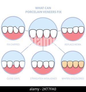 veneers dental vector Stock Vector Image & Art - Alamy