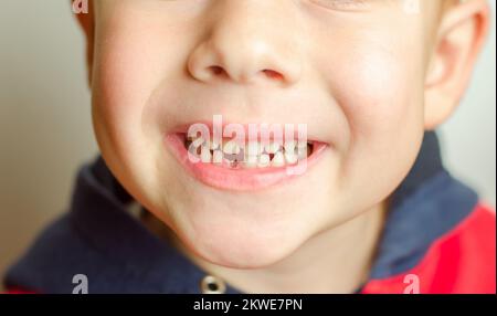 The open mouth of a child without one tooth. Loss of milk teeth Stock ...