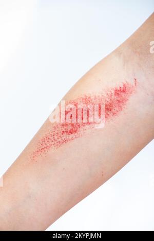 Children's hand burn. Children's hand with a burnt wound on a white ...