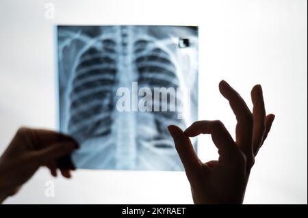 The doctor looks at the x-ray of the patient's lungs and shows the ok ...