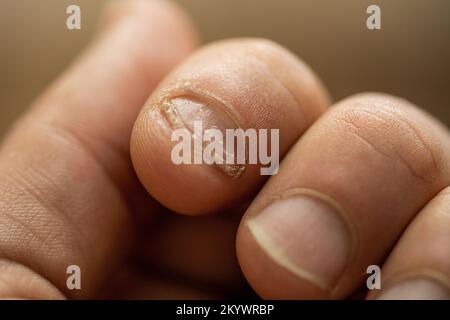 Onychophagy. Close up of fingers with eaten nail. Anxiety and nerves Stock Photo - Alamy