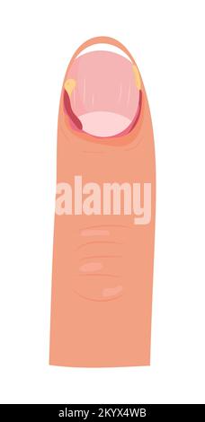 Paronychia concepnt vector for medical blog, app, banner. Nail ...