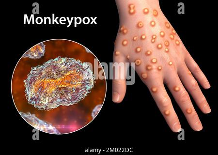 Monkeypox infection, illustration Stock Photo - Alamy