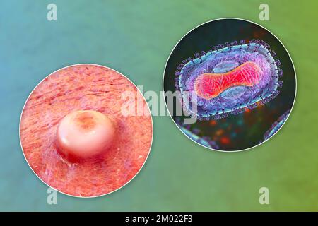 Skin lesions in monkeypox infection, illustration Stock Photo - Alamy