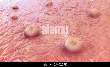 Skin lesions in monkeypox infection, illustration Stock Photo - Alamy