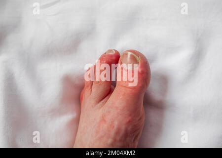 Chilblains on toes, red itchy bumps, swelling Foot of person with ...