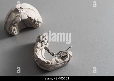 Plaster models of dental prostheses. Demonstration models of dentures ...
