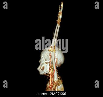 Brachial Arteries of the arm with Upper extremity Bone 3D rendering ...