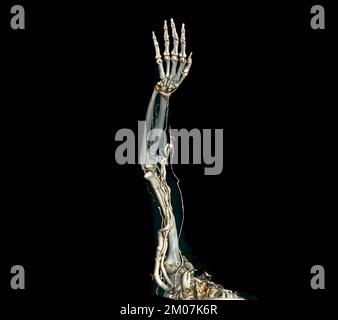 Brachial Arteries of the arm with Upper extremity Bone 3D rendering ...
