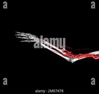 Brachial Arteries of the arm with Upper extremity Bone 3D rendering ...