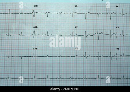 An ElectroCardioGraph ECG, a chart that draws the electricity of the ...