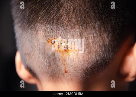 The lacerated suture wound of head which suture by nylion suture about ...