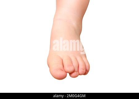 Deformed toes on the foot of the toddler baby, congenital curvature ...