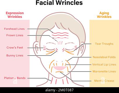 Expression wrinkles and Aging wrinkles ( female face ) vector ...