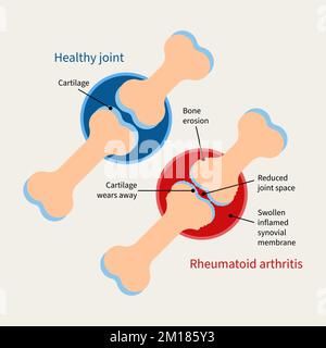Rheumatoid arthritis. Healthy and damage joint. Close-up of bone ...