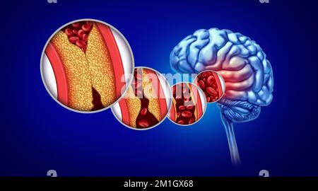 Atherosclerosis And Stroke as a Brain disorder caused by blood cells ...