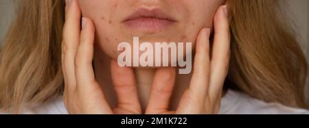 Unrecognizable woman showing her acne on face. Close-up acne on woman's ...