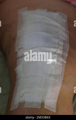 The surgical suture is covered with a gauze dressing. Total knee joint ...