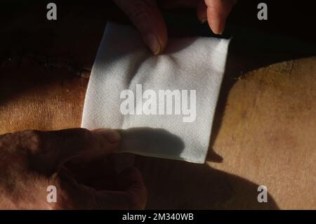 The surgical suture is covered with a gauze dressing. Total knee joint ...