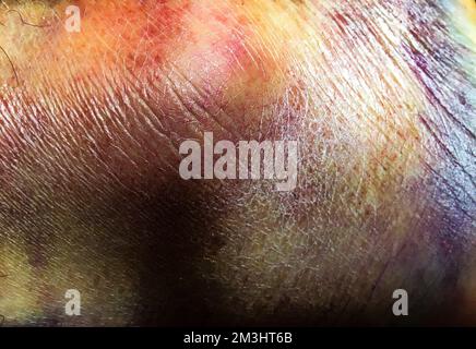 Coloured bruises, sprained, dislocated ankle. Abstract shades, skin ...