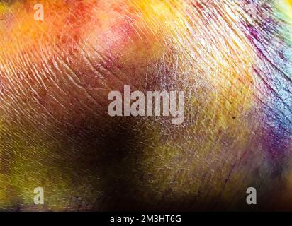 Coloured bruises, sprained, dislocated ankle. Abstract shades, skin ...