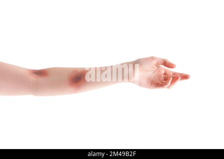 Bruised female hand on white background Stock Photo - Alamy
