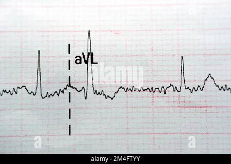 ECG ElectroCardioGraph paper that shows Normal Sinus Rhythm NSR with ...