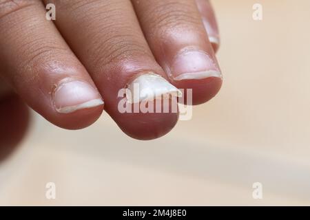 Macro of the fingers of a child who is losing a fingernail after trauma ...