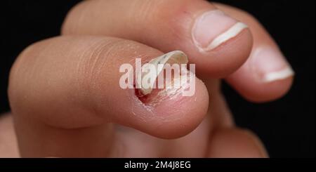 Macro of the fingers of a child who is losing a fingernail after trauma ...