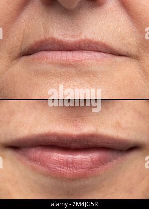 Comparison between old and young lips. Problem of wrinkles and dry ...