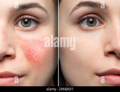 Before and after acneiform rosacea treatment. Red pimple cheek of a ...